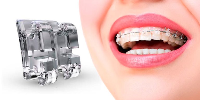 Brackets de Zafiro en Tacna | Totalmente Estéticos