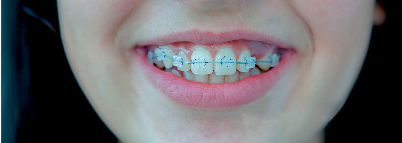 Brackets De Resina Para Ortodoncia Cuáles Son Los Mejores Brackets