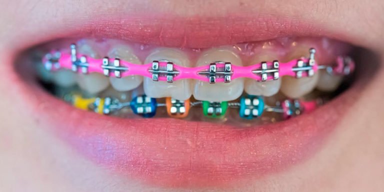 Brackets de colores | Tu sonrisa de colores - Dental Tacna