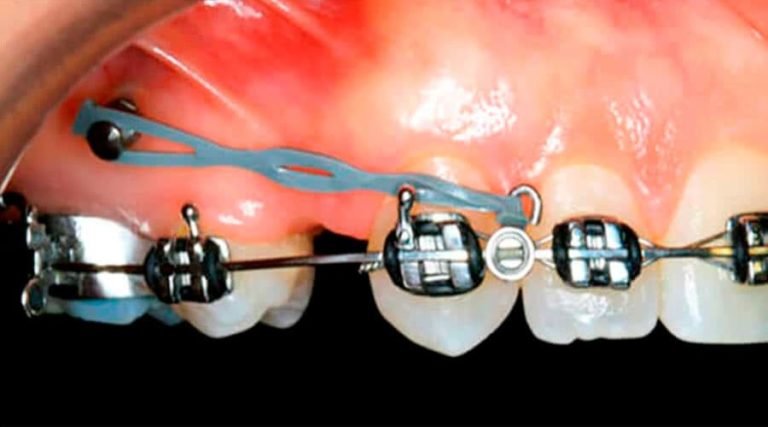 Ortodoncia con Mini implantes | Clínica Dental Tacna
