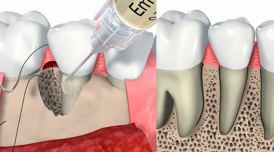 Regeneraci n Tisular Guiada Cl nica Dental Tacna